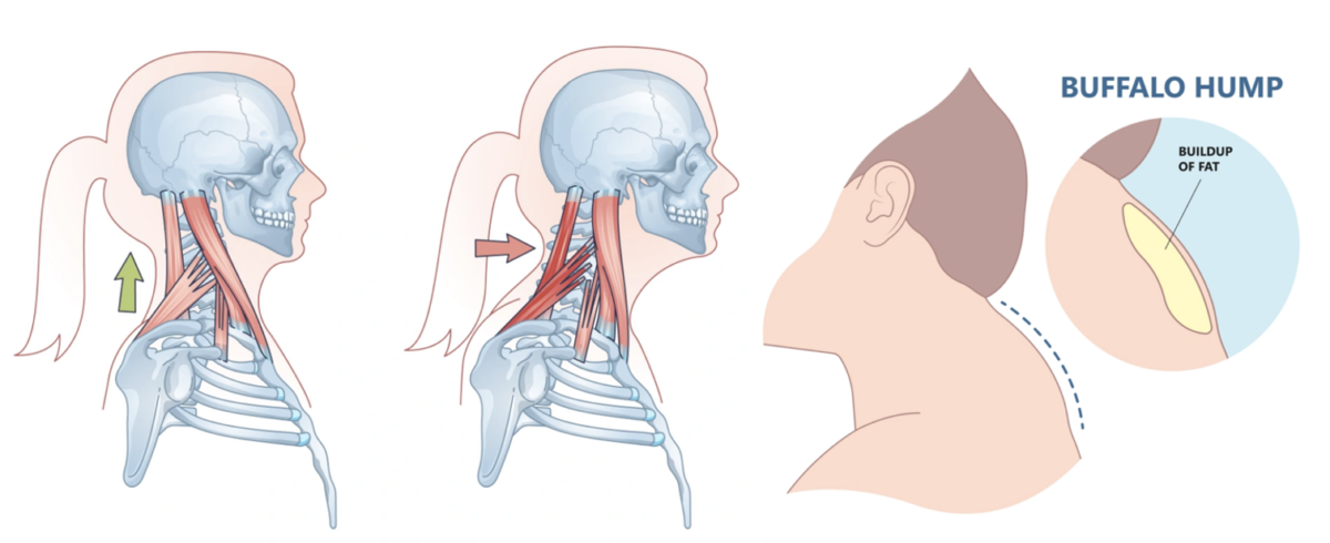 The Impact of Forward Head Posture on Your Body: Recognizing the ...